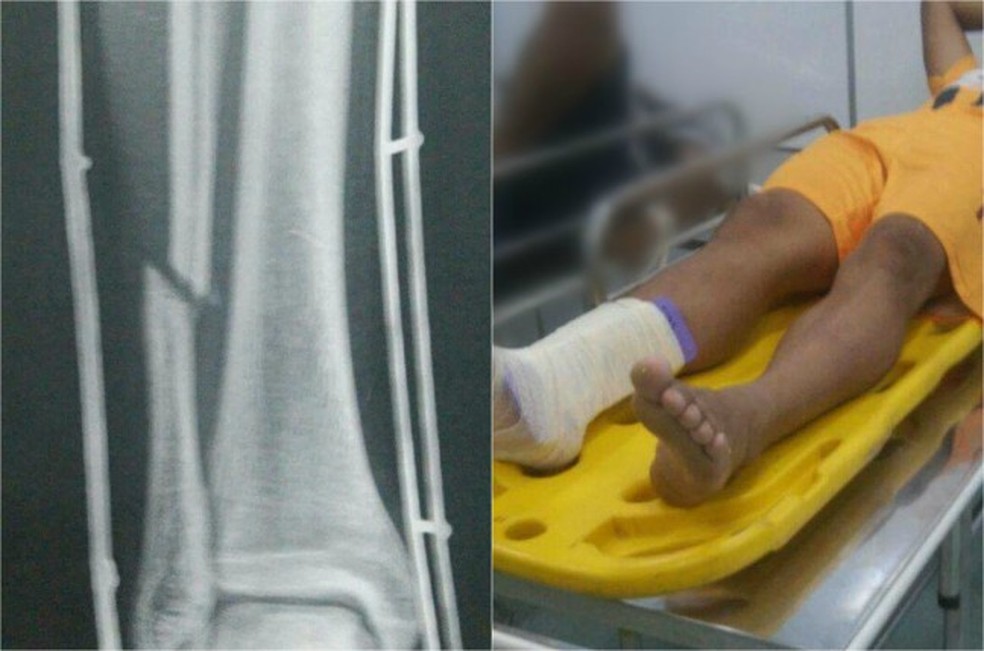 Cirurgia De Fratura De Tibia E Fibula