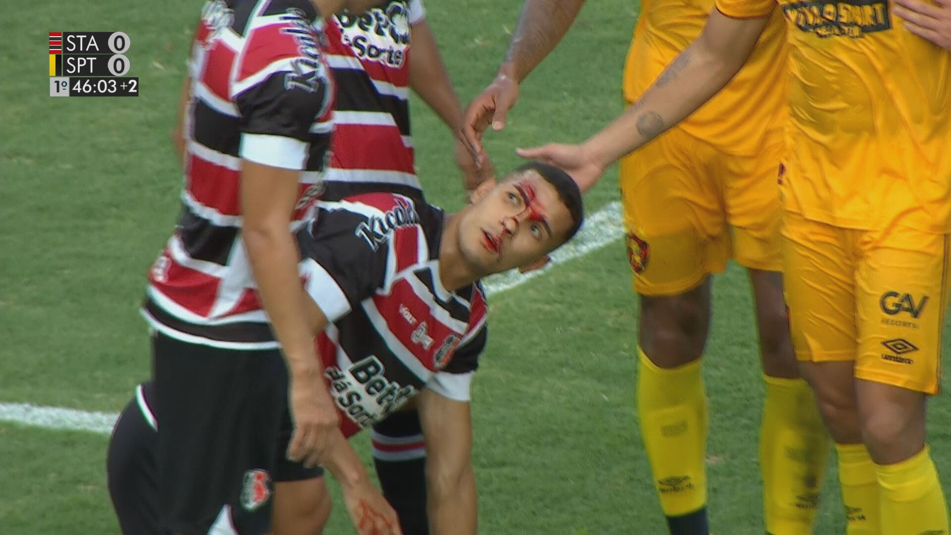Jogador do Santa Cruz sofre corte e sangra após choque de cabeça; veja ...