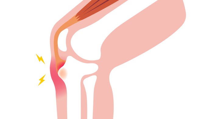Doenca De Osgood Schlatter Sequelas Da Síndrome De Osgood Schlatter
