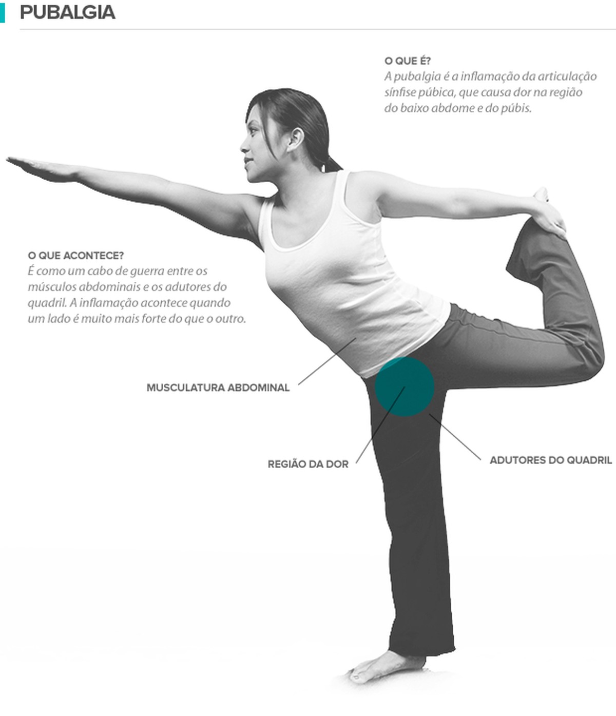 Pubalgia: o que é, sintomas e tratamento para a lesão e dor na virilha