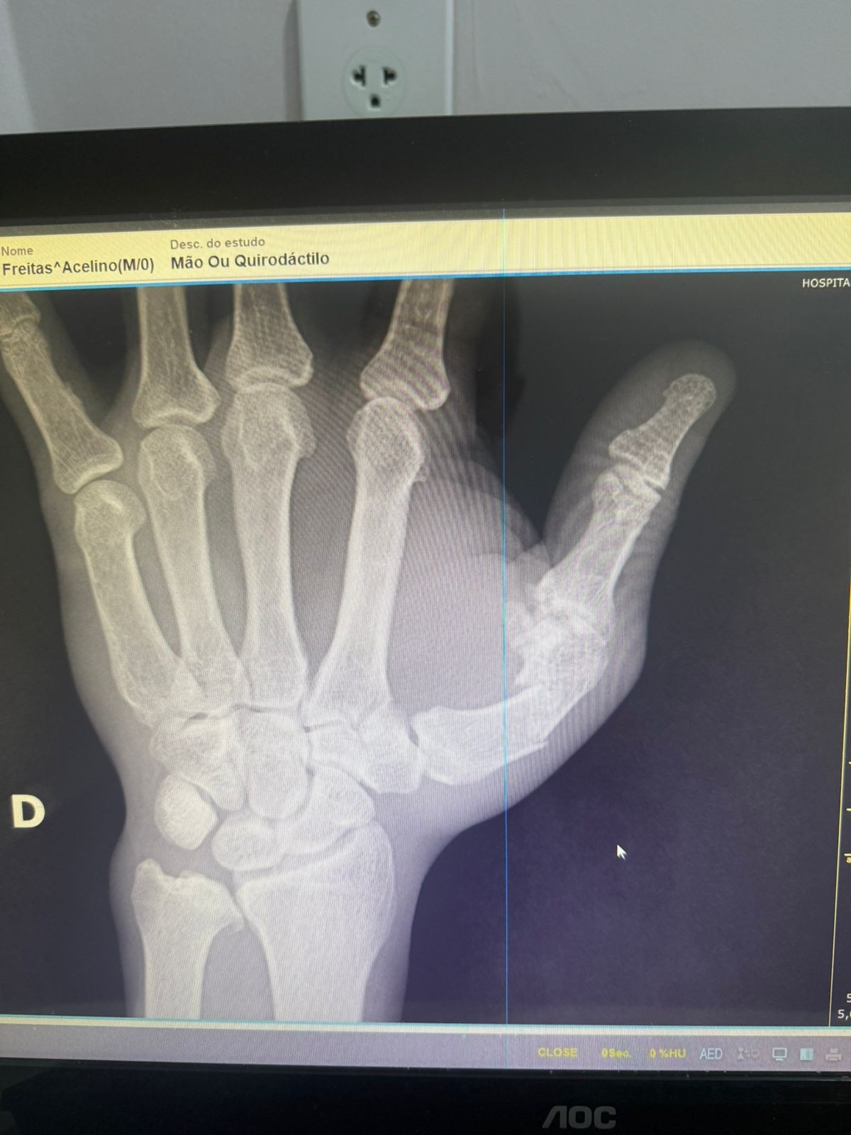 Popó conclui cirurgia após briga no Spaten Fight Night | Ge
